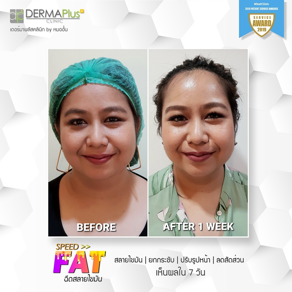 FATT-Bom – Dermaplus Clinic Phuket by หมออั๋น