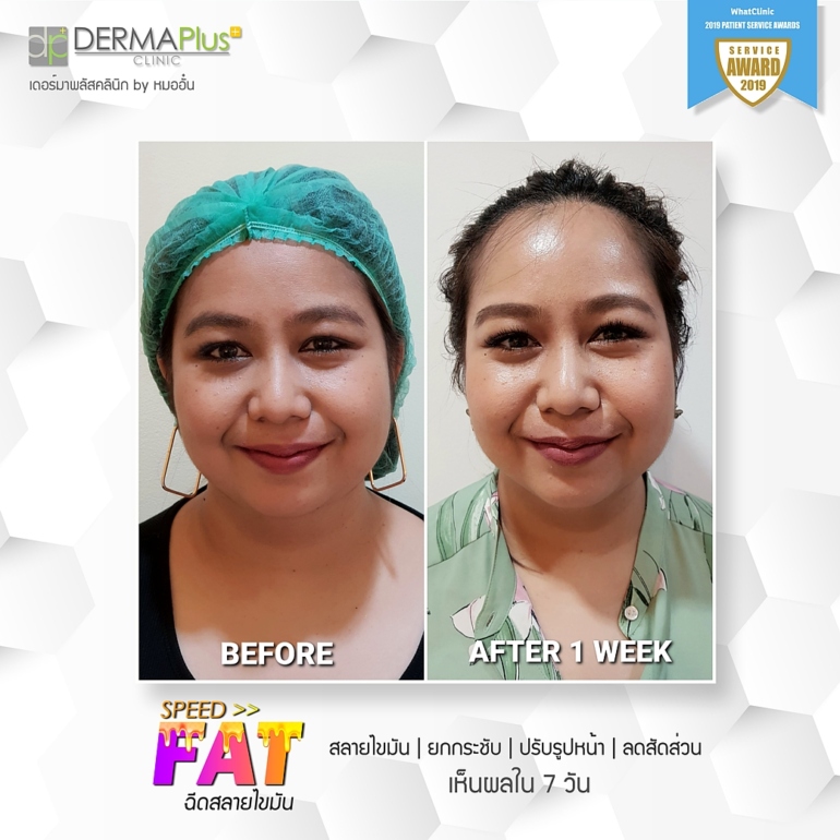 FATT-Bom – Dermaplus Clinic Phuket by หมออั๋น