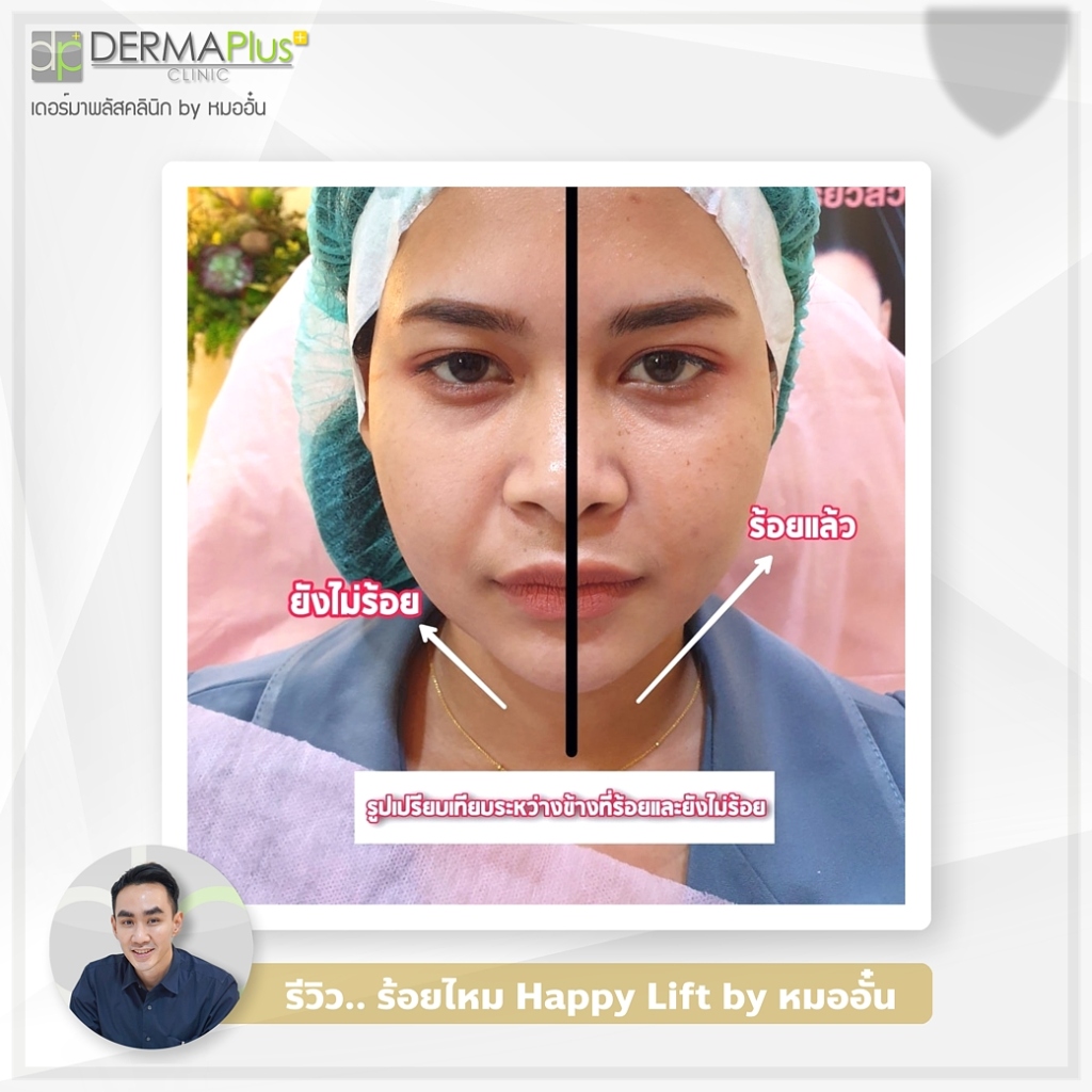 Review-HappyLift1212 – Dermaplus Clinic Phuket by หมออั๋น